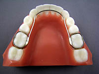 Types of Appliances - Cheek-Hill Orthodontics | Raleigh NC