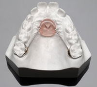 Types of Appliances - Cheek-Hill Orthodontics | Raleigh NC