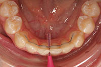 Retainers - Cheek-Hill Orthodontics | Raleigh NC